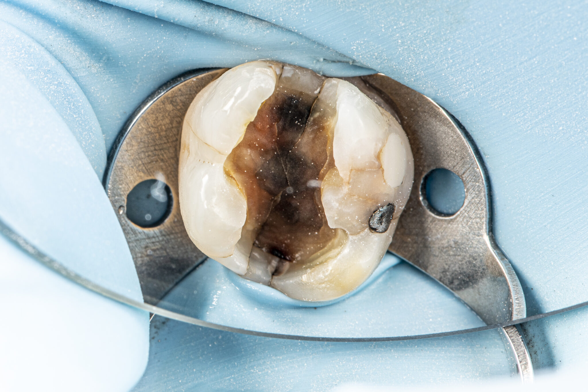 Study Club - STUDY CLUB - CRACKED TOOTH SYNDROME: filling the void with ...